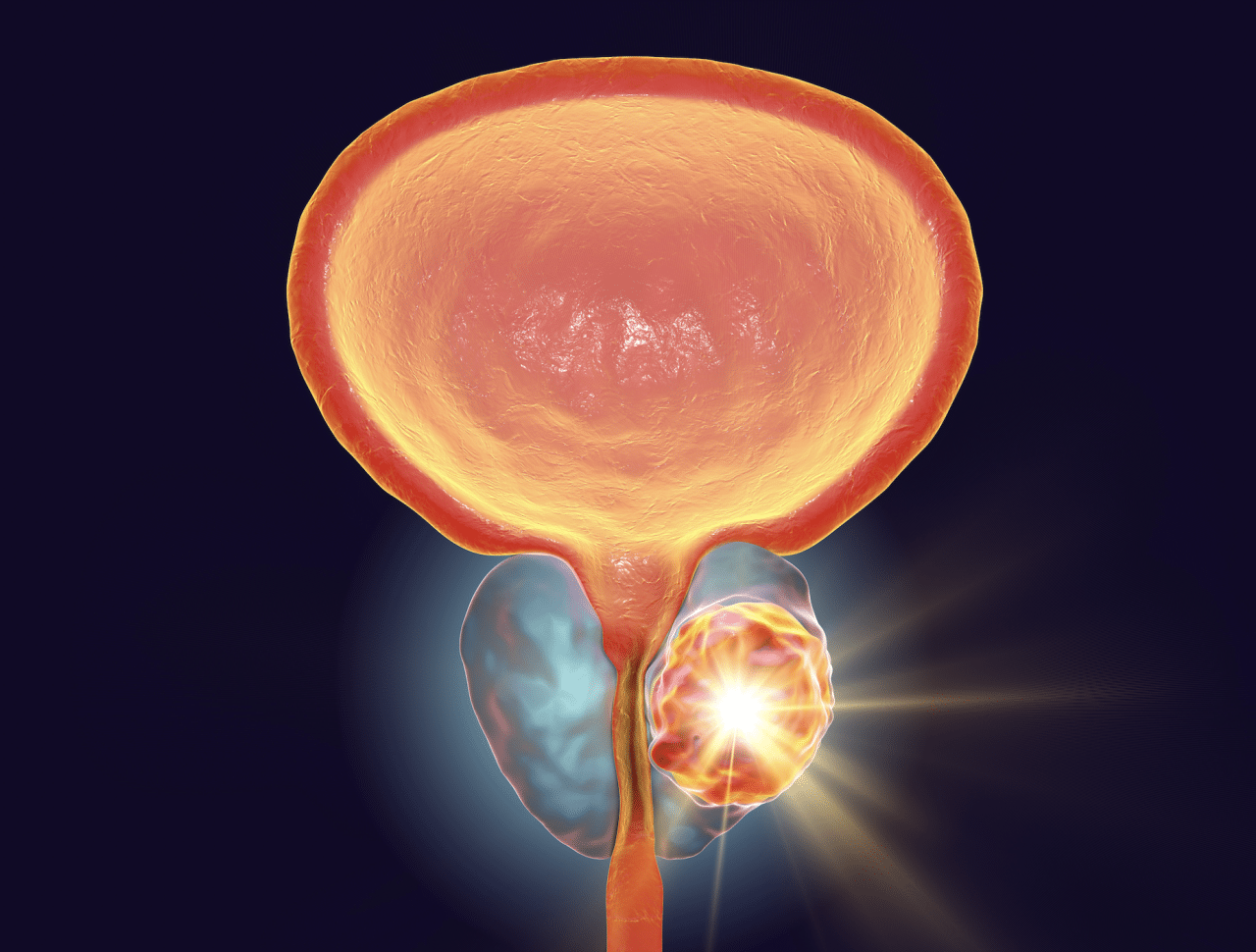 Prostate Cancer | Doctors Studio